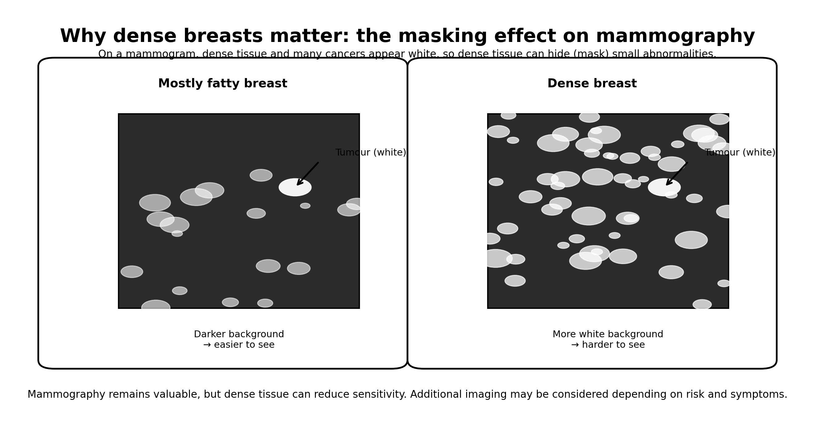 Dense breasts explained - International Ultrasound Services