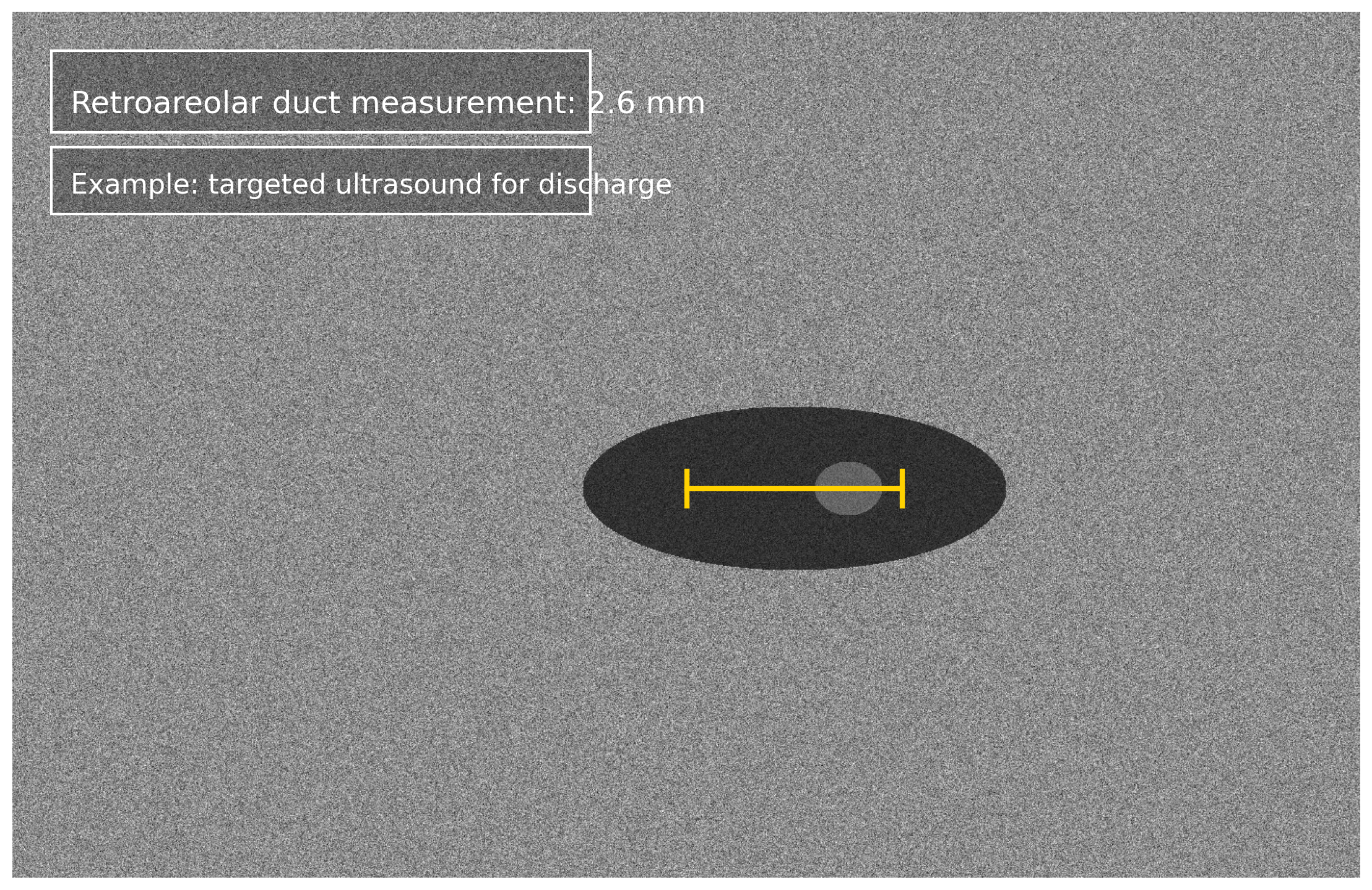 Nipple discharge: causes and assessment - International Ultrasound Services